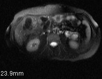 Omental Fat Necrosis - Sumer's Radiology Blog