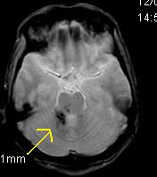 Chronic Trauma with Diffuse Axonal Injury-MRI - Sumer's Radiology Blog