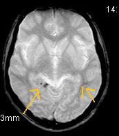 Chronic Trauma with Diffuse Axonal Injury-MRI - Sumer's Radiology Blog