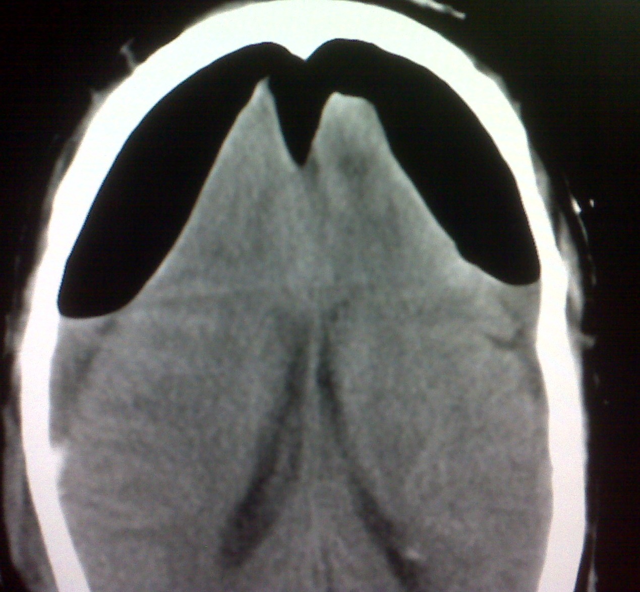 Mount Fuji Sign-CT - Sumer's Radiology Blog