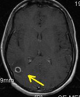 DWI- intracranial tuberculoma & tuberculous abscess versus cysticercus ...