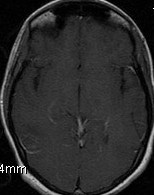 DWI- intracranial tuberculoma & tuberculous abscess versus cysticercus ...