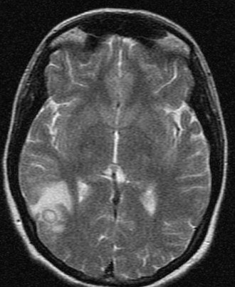 DWI- intracranial tuberculoma & tuberculous abscess versus cysticercus ...