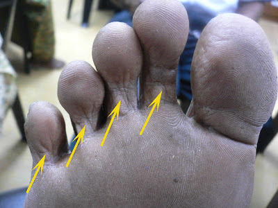 Modern & Multidimensional Iridology: Foot Glyphology Analysis - 50