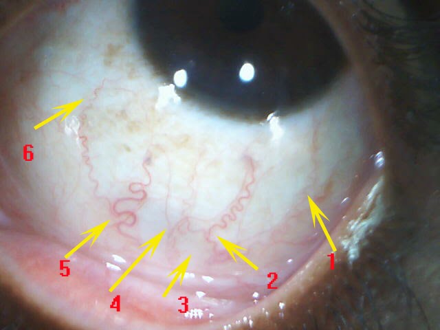 Modern & Multidimensional Iridology: Sclerology Analysis - 27