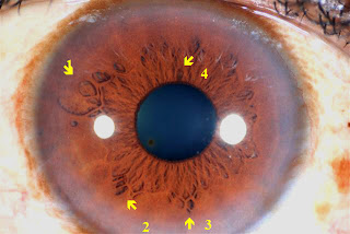 Modern & Multidimensional Iridology: An Analysis of Lacunae