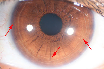 Modern & Multidimensional Iridology: Iridology Analysis- 14