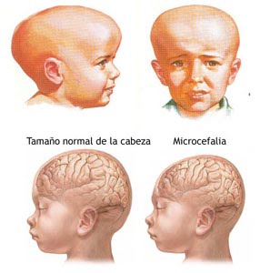 TODO LO QUE QUIERES SABER ACERCA DE LA MICROCEFÀLIA Y EL SÌNDROME DE ...
