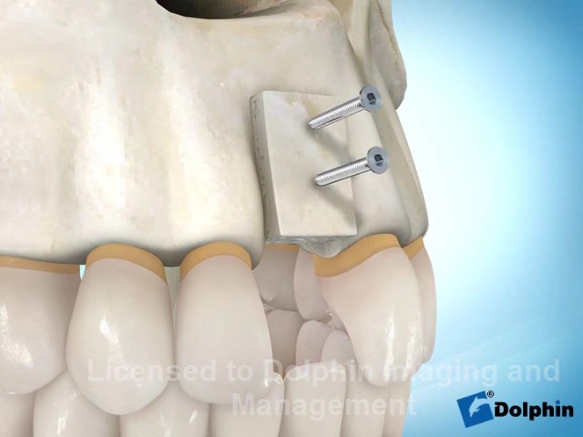 doctors videos backup: Dentistry: Block Bone Graft for Implant [HQ]