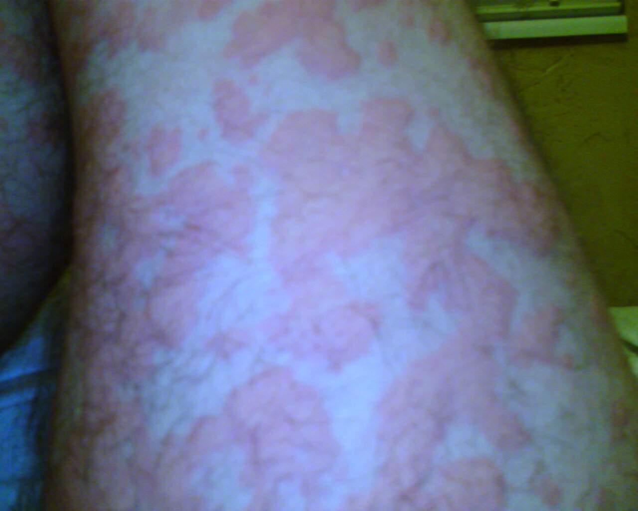 Help for Meth Exposure