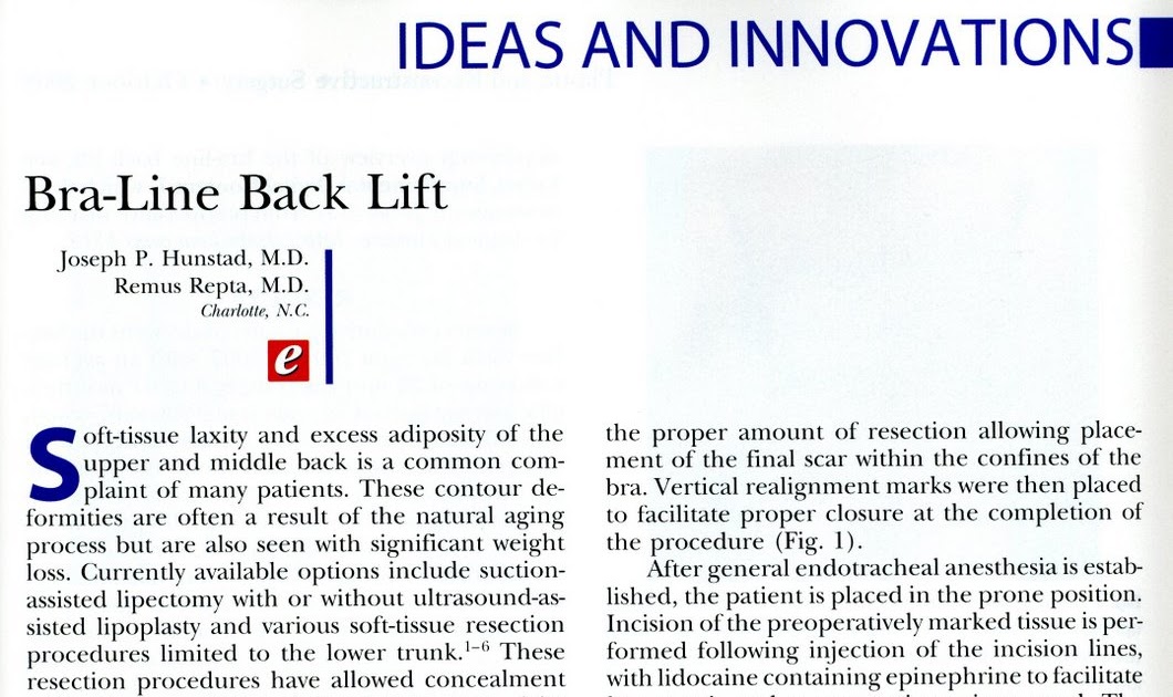 What Is A Bra Line Back Lift at Juan Bear blog