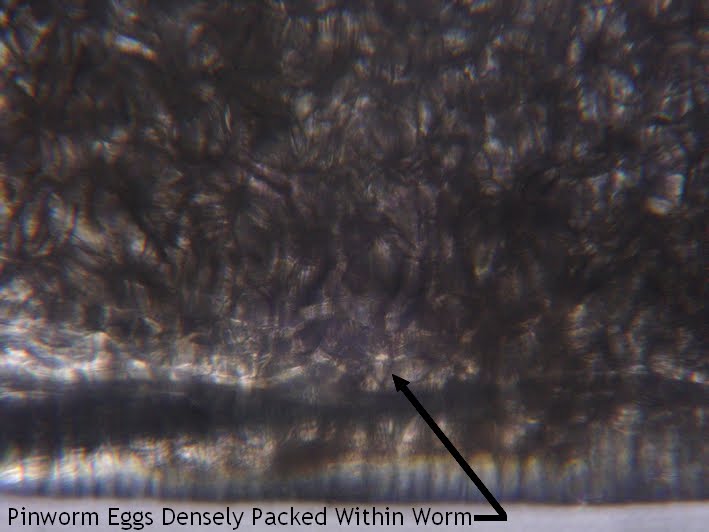 Fun With Microbiology (What's Buggin' You?): Enterobius vermicularis ...