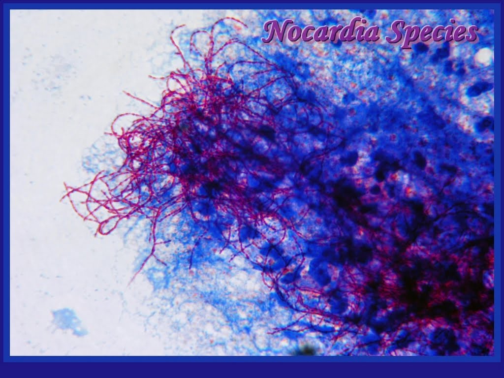 Fun With Microbiology (What's Buggin' You?): Nocardia species