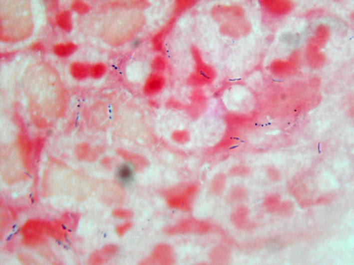 Fun With Microbiology (What's Buggin' You?): Mycobacterium tuberculosis ...