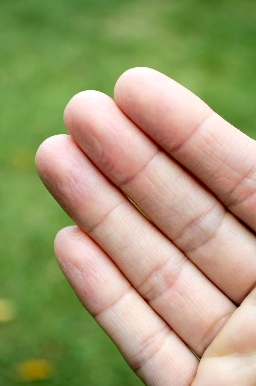 glazedOver: How to Soothe a Burn