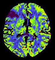 Aplikasi Klinik Multi Slice CT Scan: Pemeriksaan Neuro Perfusion