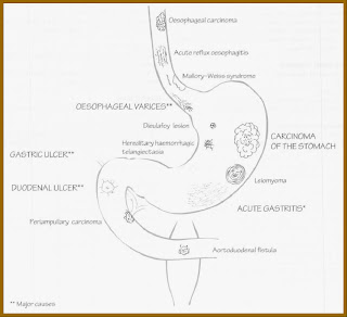 Discovery of Heart: Causes of Haematemesis (Vomiting of Blood)