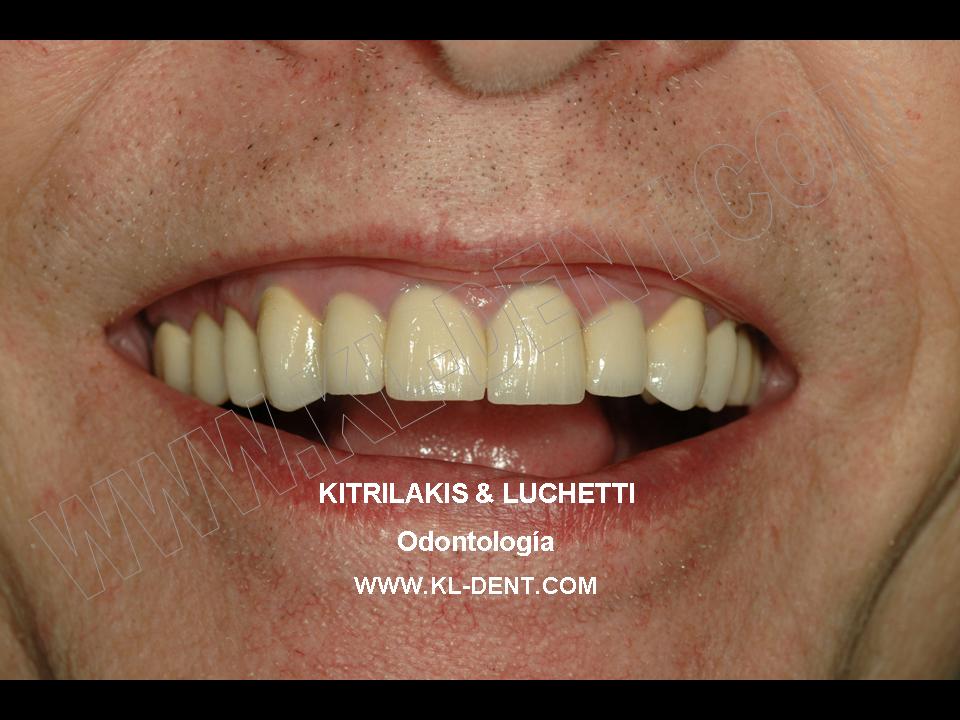 Kitrilakis & Luchetti - Dentistry: Fixed Prosthodontics: Complete ...