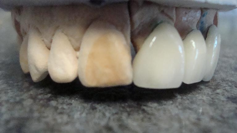 tecnologia dental: METAL PORCELANA