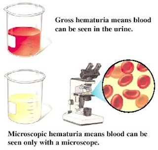 Medical World: Hematuria