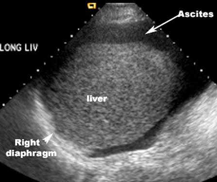 Medical World: Ascites