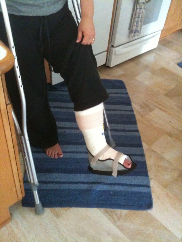 Sprained Ankle Cast