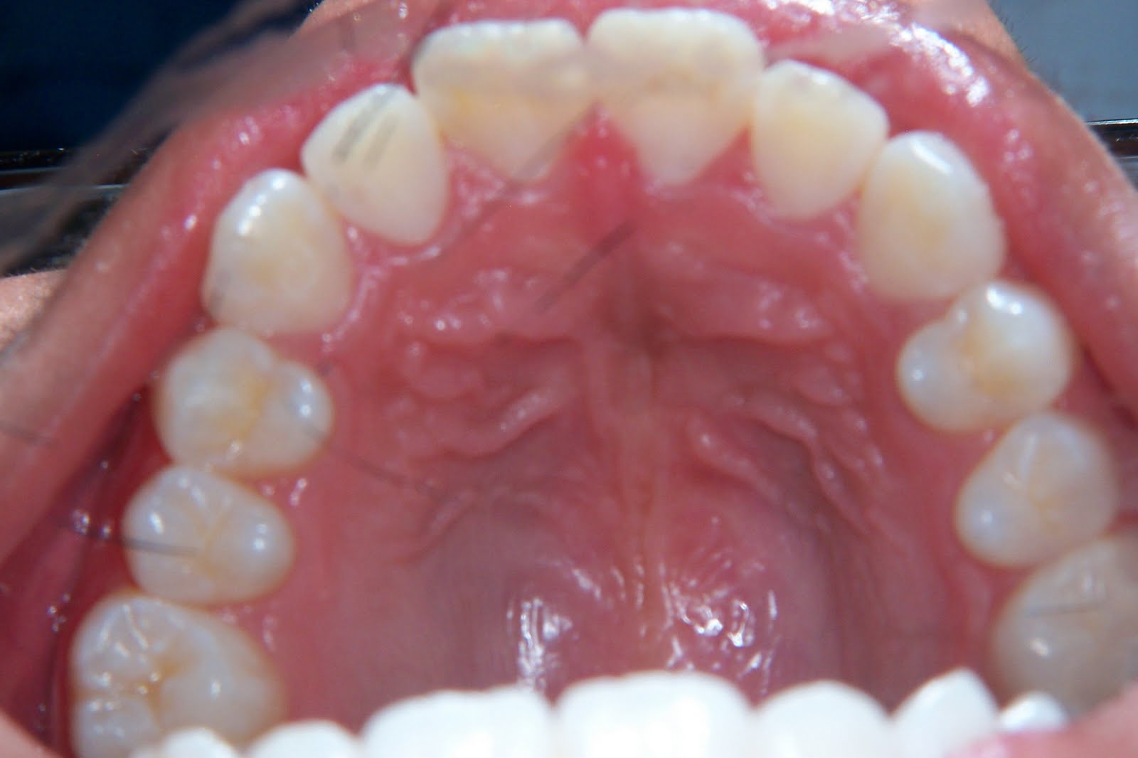 invisaligninfo: Invisalign Before and After Cases