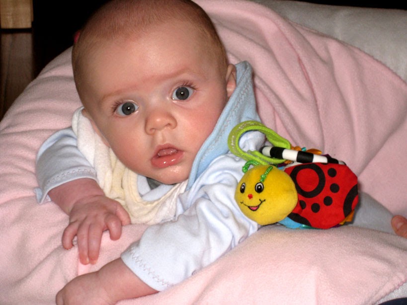 Boston Twins: Colin's Strawberry Birthmark - Strawberry Hemangioma