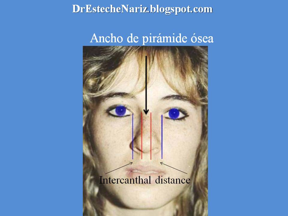 Dr Esteche | Rinoplastia | Cirugía | Plástica de Nariz | Nose |Surgery ...