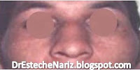 Dr Esteche | Rinoplastia | Cirugía Plástica de Nariz: Rinoplastia | 6 ...