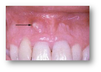 alteraciones bucales complicadas: Absceso periapical agudo