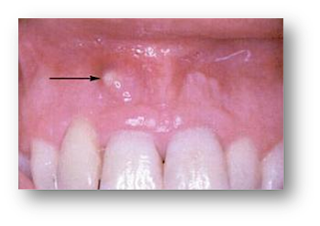 alteraciones bucales complicadas: Absceso periapical agudo