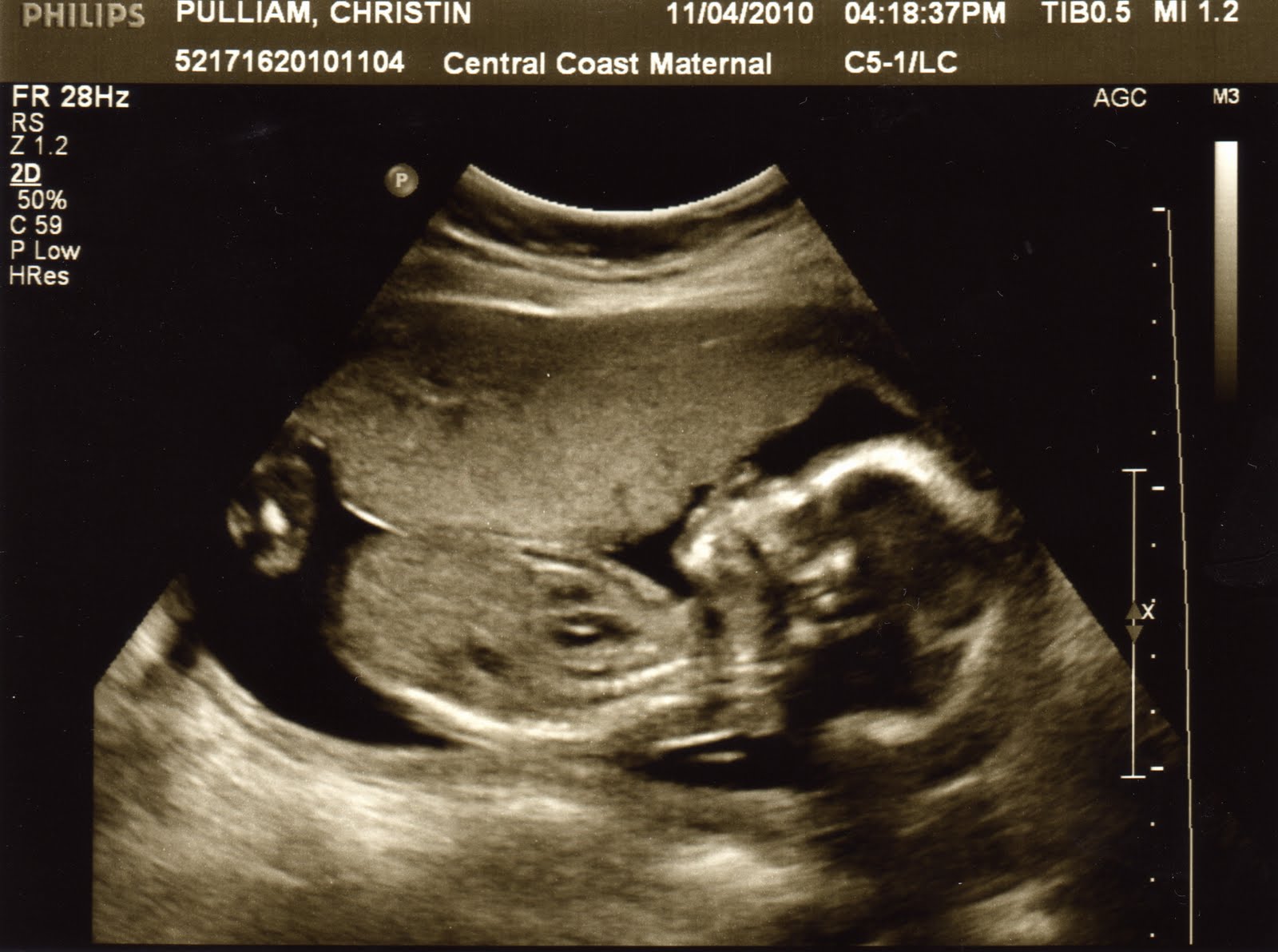 Seven Is Our Lucky Number: Ultrasound 19 weeks