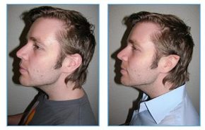 Body Modification- Is it an ideology?: Pointed elf ears cosmetic ...