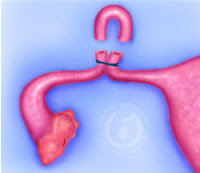 Post Tubal Ligation Syndrome is Real!: Types of Tubal Ligation