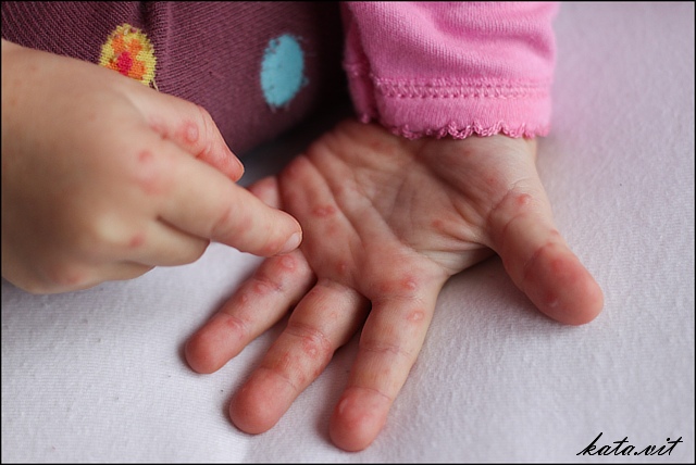 Vítovi: rukou nohou úst