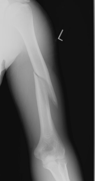 A&P Blog: Bone Fractures