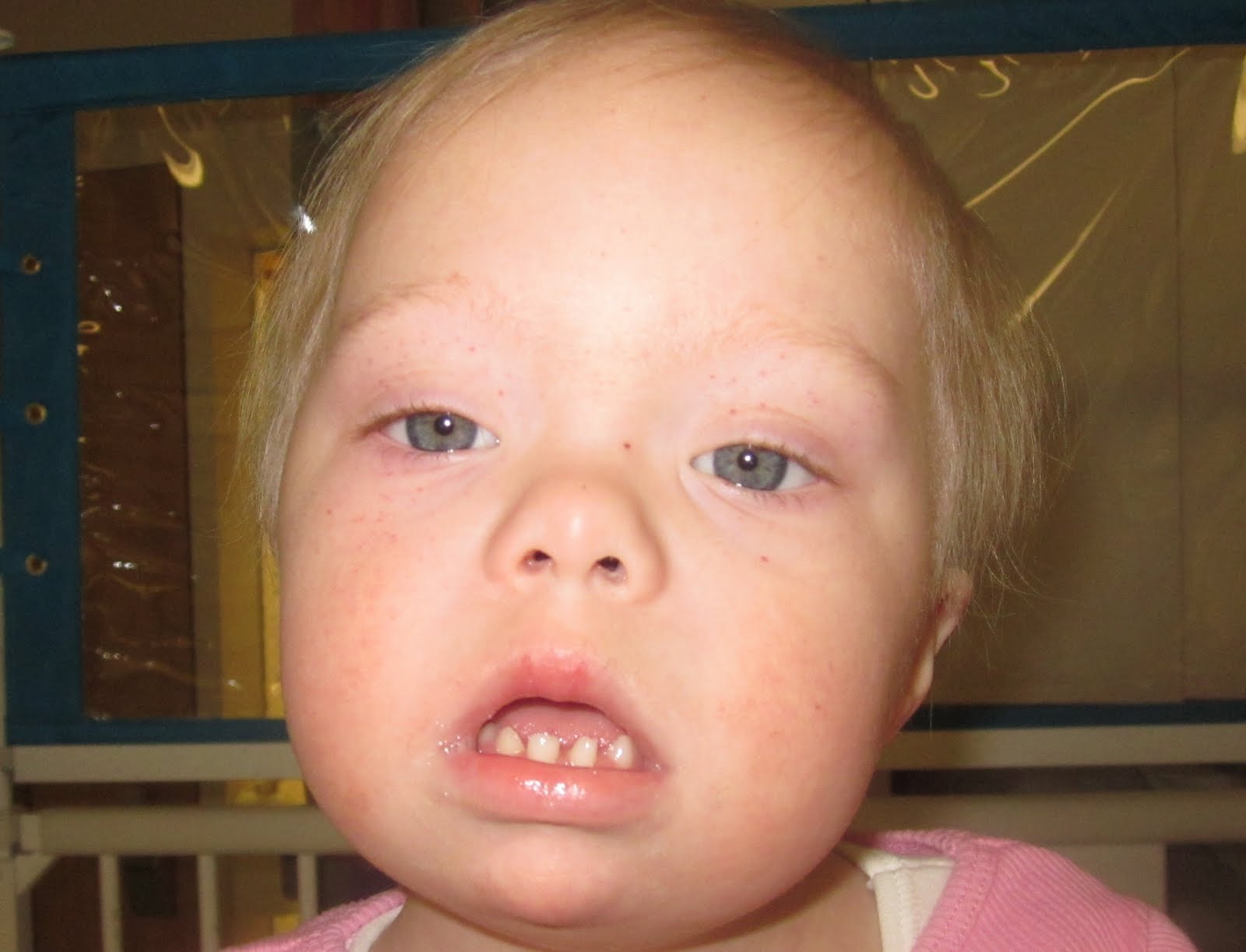 Sweet Ella Grace: Petechiae