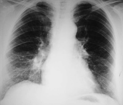 O Radiologista: Bronquiolite Respiratória