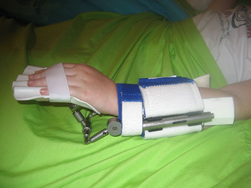 Jessie's Blog: Jessie's Dyna-Splints