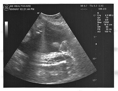 Ultrasound Pictures