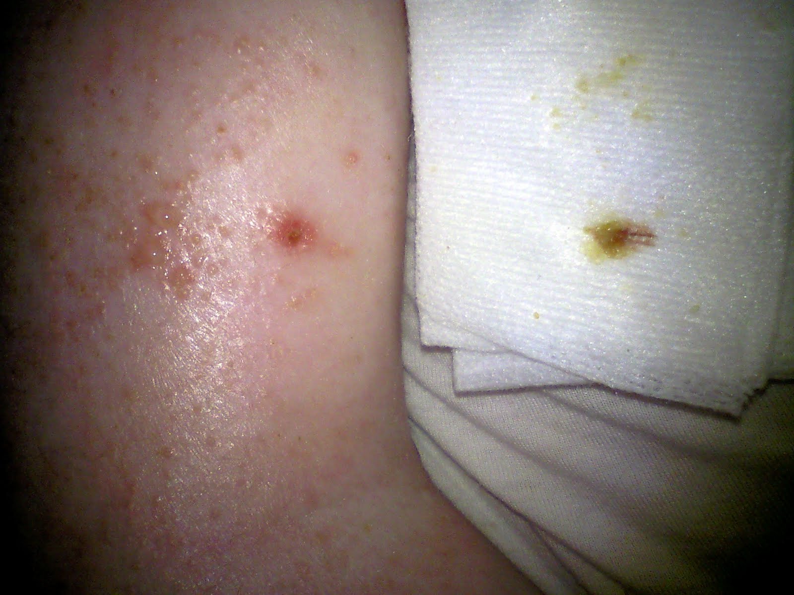 Benjamin McKay Orton: PICC LINE GONE