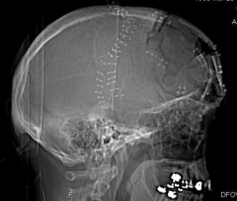 My CranioFacial Surgery: Before and After Pictures - Revisited
