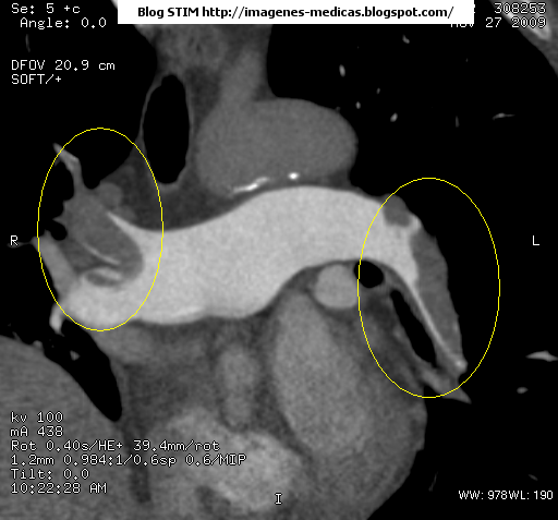 Sobre técnicas de imágenes médicas (Blog STIM): Tromboembolismo Pulmonar (TEP) y Tc multicorte ...