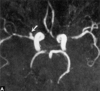 CT Pathology Blog: CTA versus conventional angiogram or DSA in ...