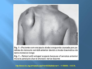 Professor Nelson: Escápula Alada