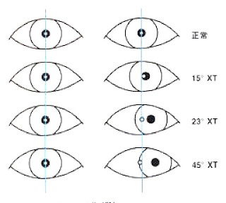dewa-dony: strabismus