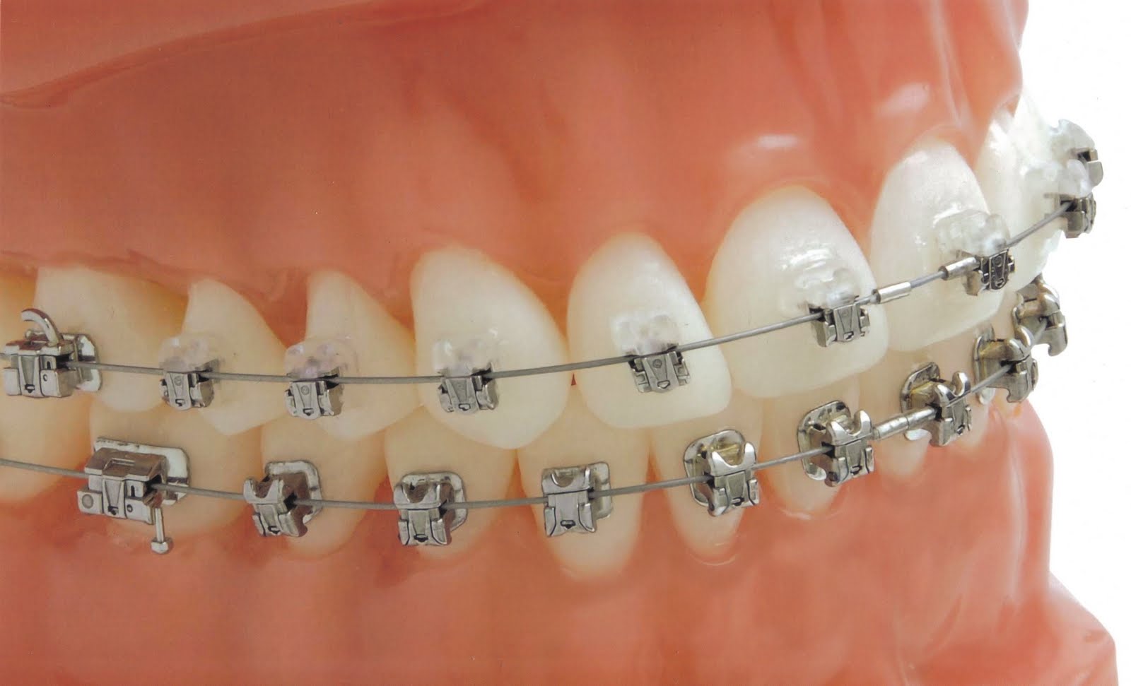 Frenillos Cerámicos Estéticos