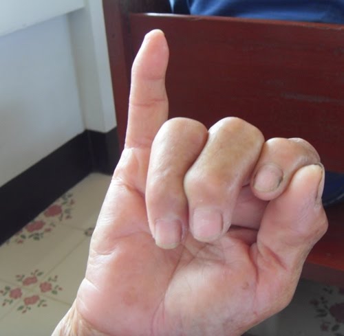 Healing and Deliverance การปลดปล่อยและหายโรค: A locked finger was ...