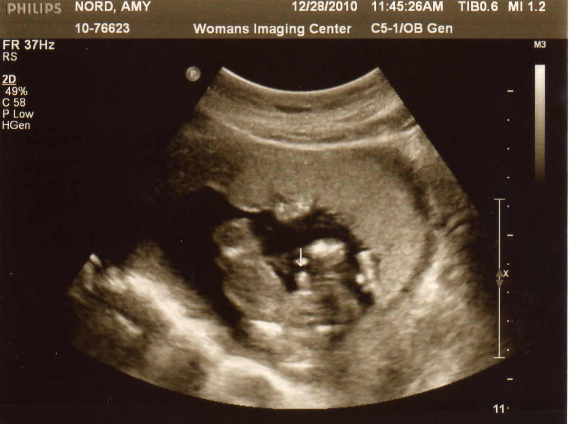 Live Laugh Love.....My Journey: Ultrasound Pics at 18 weeks in the ...